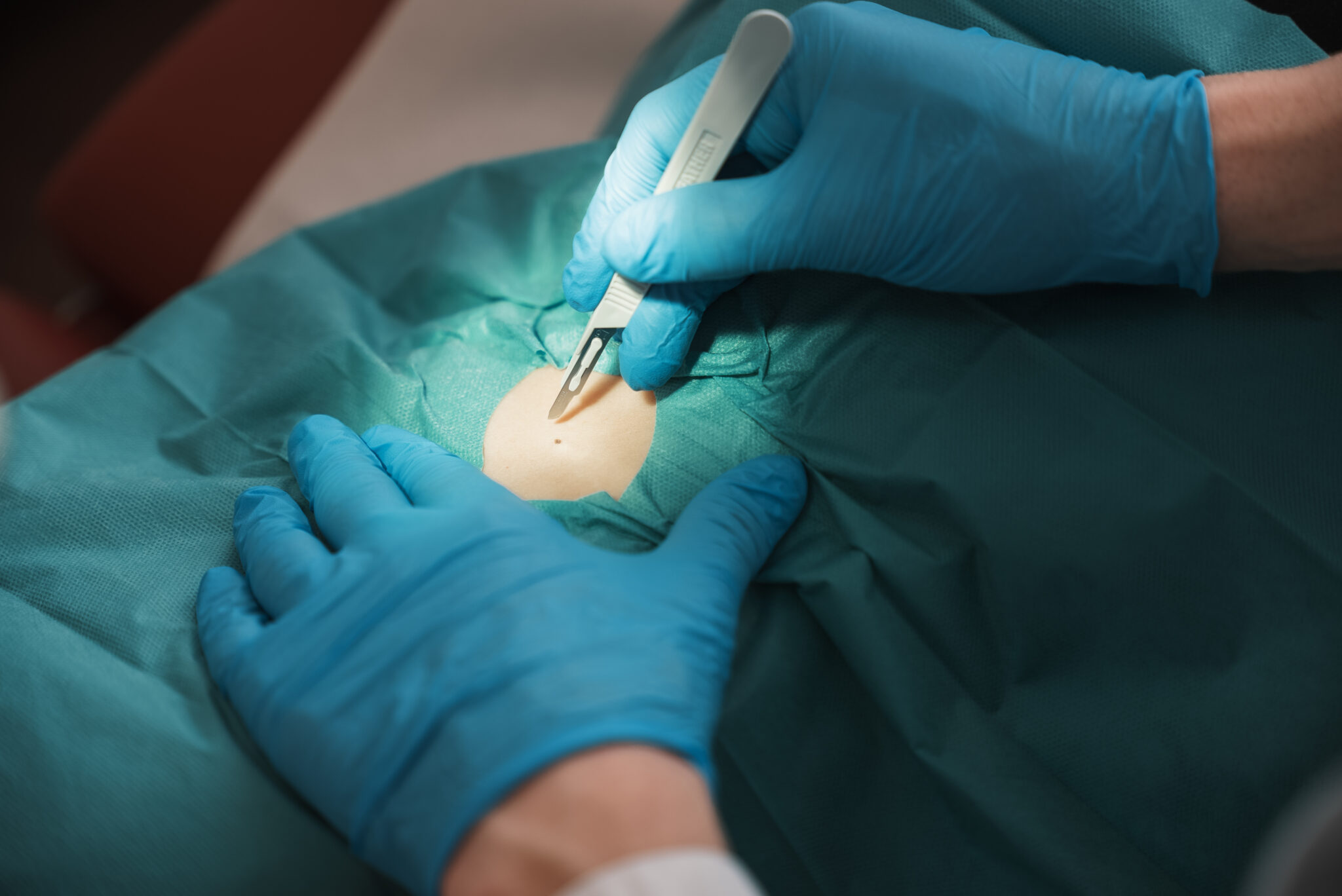 Outpatient operations - Skin surgery Frankfurt