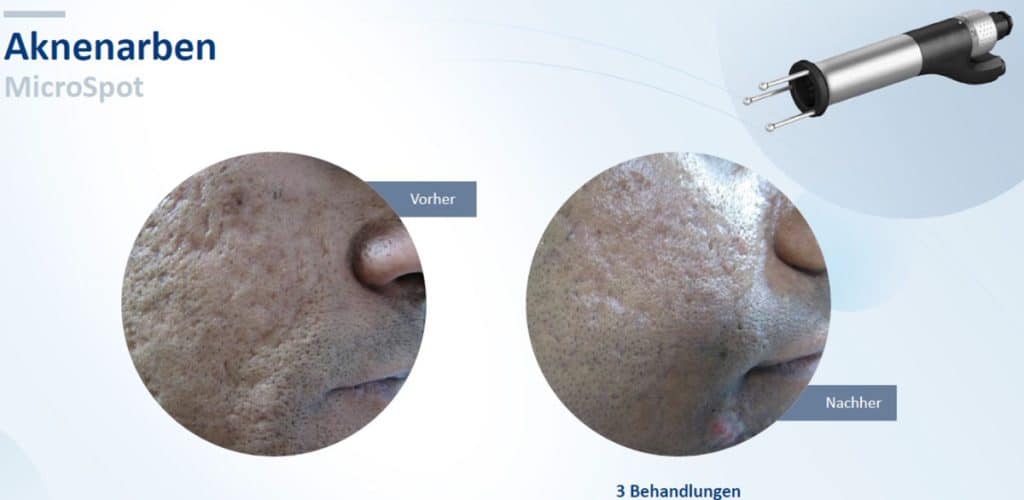 Akne Behandlung Frankfurt - Hautarzt am Schweizer Platz